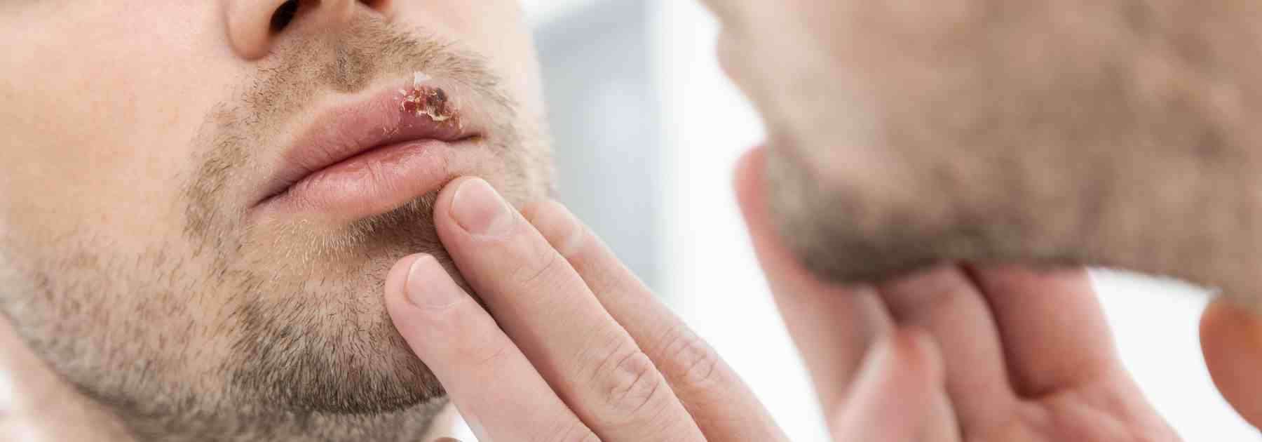 Cold Sores 101: Everything You Need to Know - R.M.Jones Pharmacy